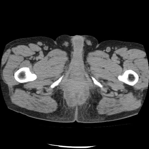 Buckeye Surgeon: Horseshoe Abscess
