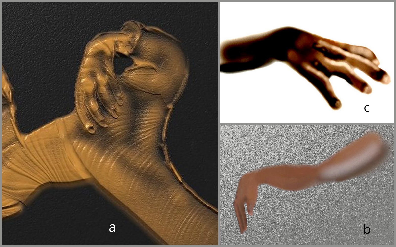 drxmarylle: Interosseous Phenomenon of Souques