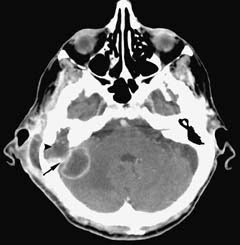 Brandy's CT Pathology Blog: Mastoiditis