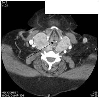 Brandy's CT Pathology Blog: Goiter