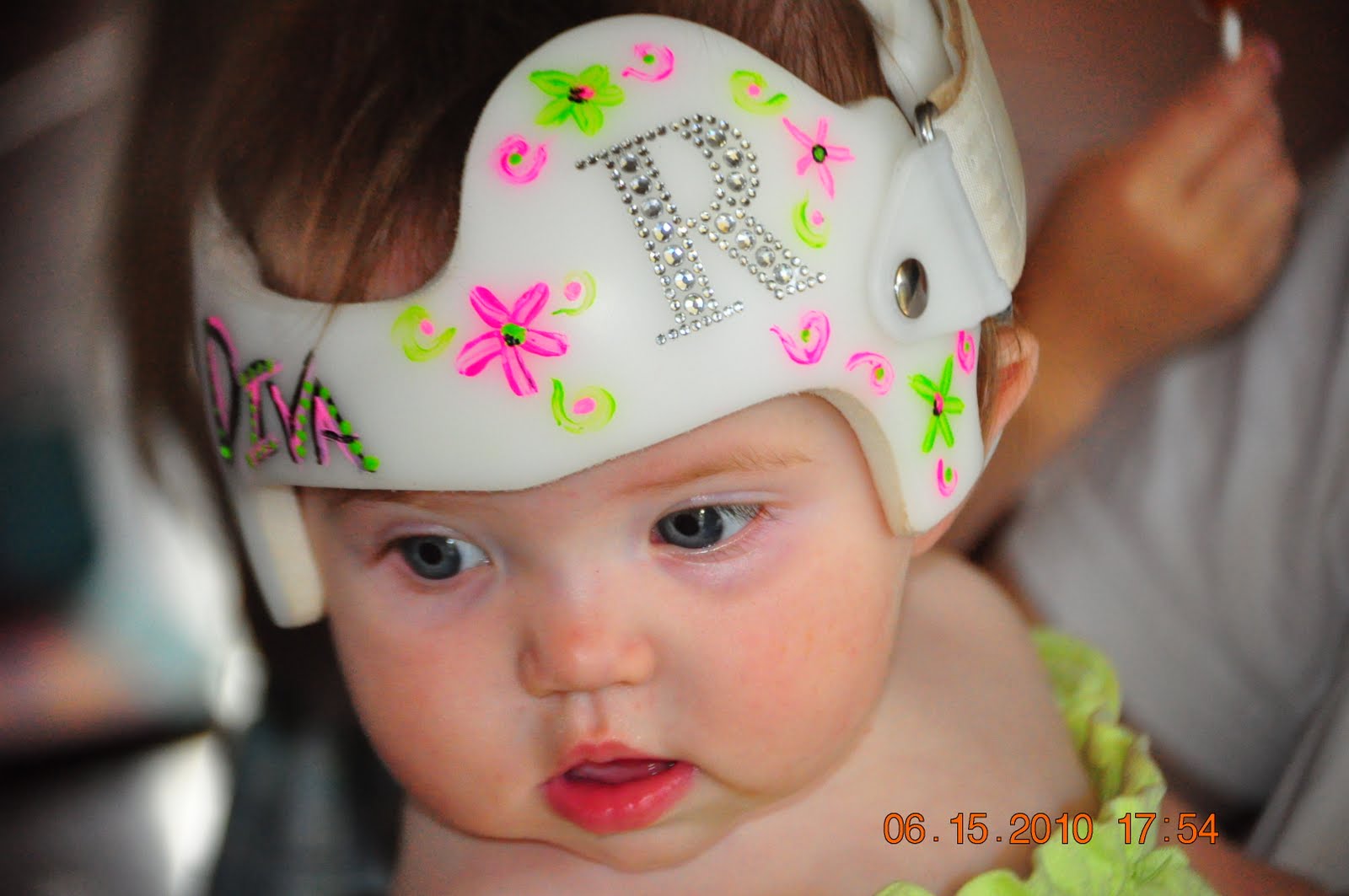 THE PRINCESS DIARIES: Dymanic Orthotic Cranioplasty (DOC Band)