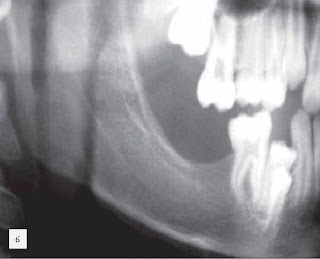 Saint Joseph's Pediatric Dentistry Lit Review: Removal of a Complex ...