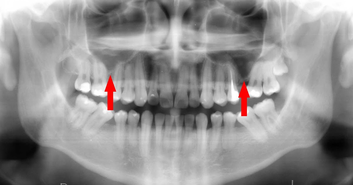 DIAGNOSTICOS POR IMAGENES: Neumatización de senos maxilares
