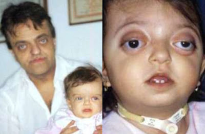 Patologia em Abordagem Fisioterápica: DISOSTOSE CRANIOFACIAL