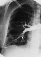 Patologia: Embolia Pulmonar