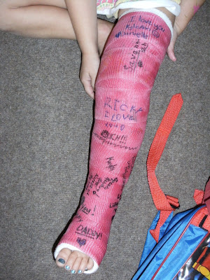 Our Slice of Turkey: Broken Leg