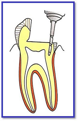 hi-DENT FINISHING SCHOOL: AMALGAM PINS