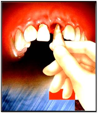 hi-DENT FINISHING SCHOOL: AVULSION AND REIMPLANTATION