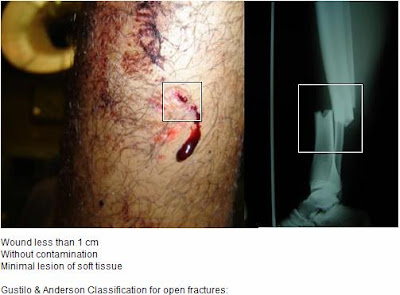 LOT: Estudo de Caso 12/05/2008 Fraturas Expostas