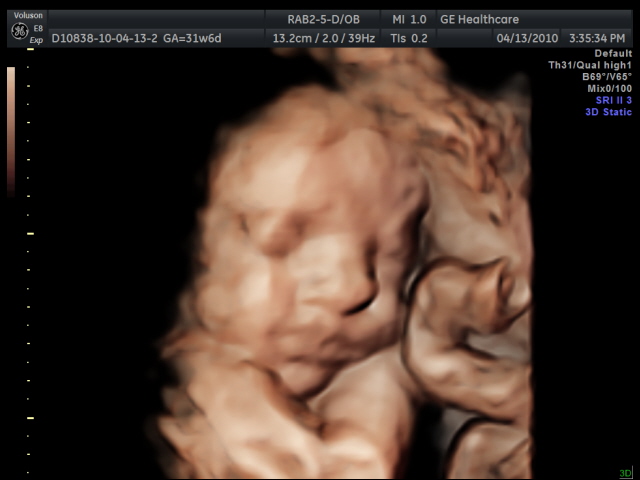 The Michaud's: 32 Weeks and 3D Ultrasound