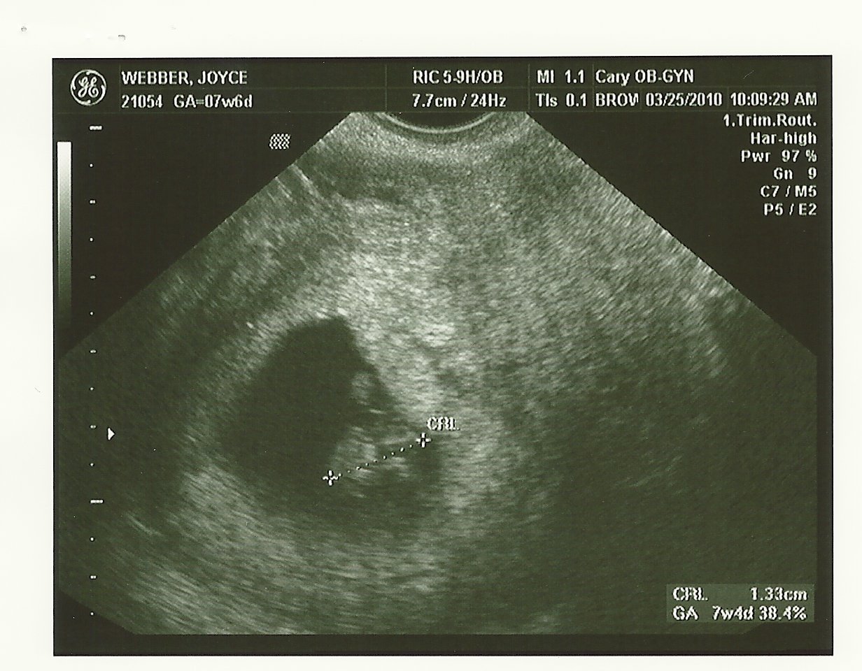 Ash & Lee Plus 3: 8 Week Ultrasound Pictures