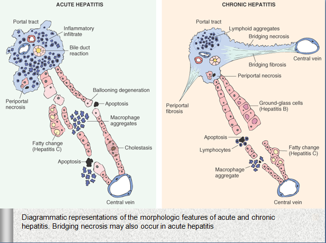MBBS Medicine (Humanity First): Comparison of Acute Hepatitis and ...