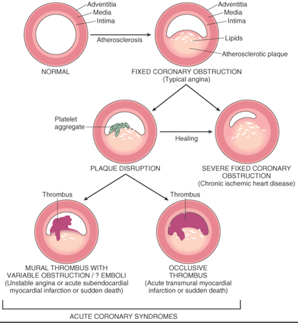 MBBS Medicine (Humanity First): CAD.(coronary artery disease)