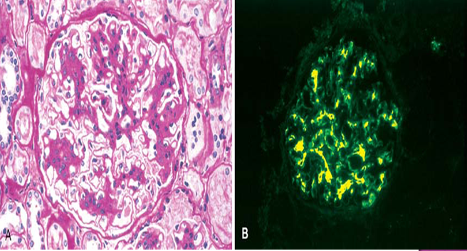 MBBS Medicine (Humanity First): IgA nephropathy. MBBS Medicine (Humanity First): IgA nephropathy.