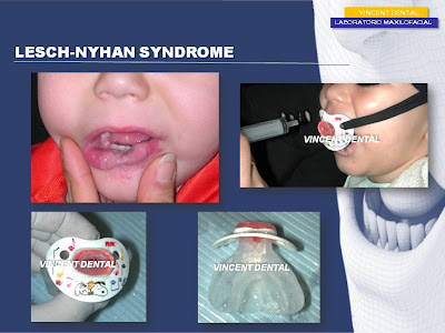 VINCENT DENTAL Laboratorio Maxilofacial: LESCH-NYHAN SYNDROME