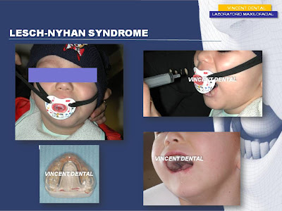 VINCENT DENTAL Laboratorio Maxilofacial: LESCH-NYHAN SYNDROME