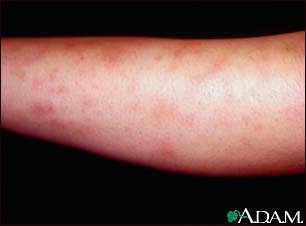 Reasonably Well: Erythema Nodosum is Not Hives