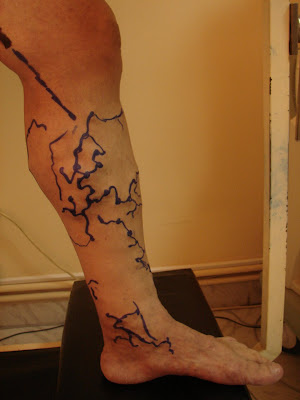 Operatii Varice, Varice, Tratament Varice, Vase Sparte,: Boala Varicoasa