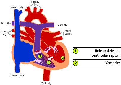 Tentorium Feby Purnama: VENTRICULAR SEPTAL DEFECT (VSD)
