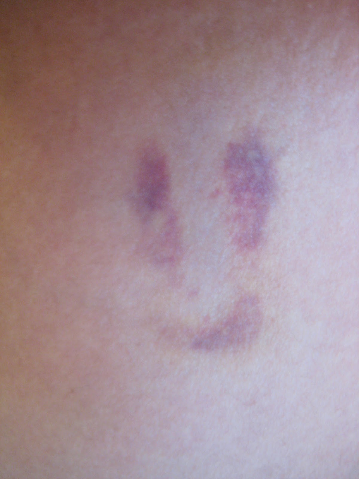Gurly Things: Happy Bruise