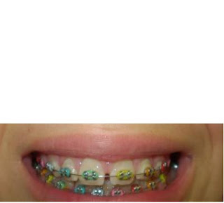 The US Abadees: Rainbow Braces