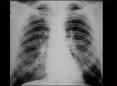 MEDICINA COMPLEMENTARIA: ENFERMEDAD DE PULMON NEGRO...Pneumoconiosis