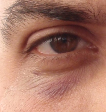 Blog Lunaro: HISTORIA DE UN OJO MORADO (5)