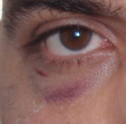 Blog Lunaro: HISTORIA DE UN OJO MORADO (3)