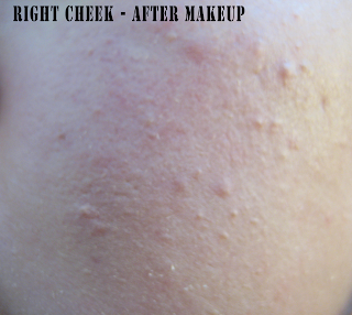 Acne Skin Care: Bare Minerals Review for Oily, Acne Prone Skin