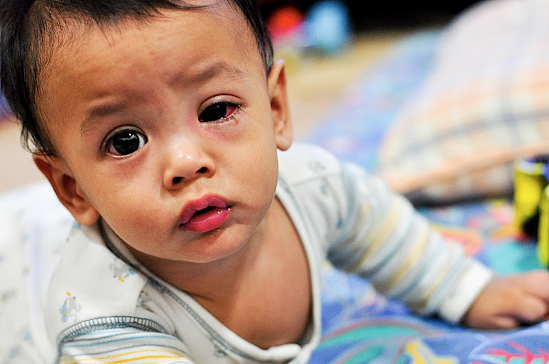 Konsep 33+ Budak Sakit Mata Sebelah