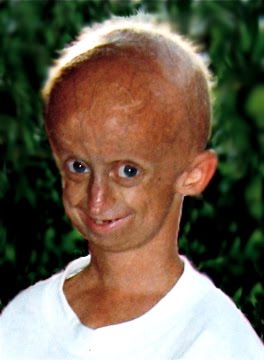 Group Of Progeria Kids
