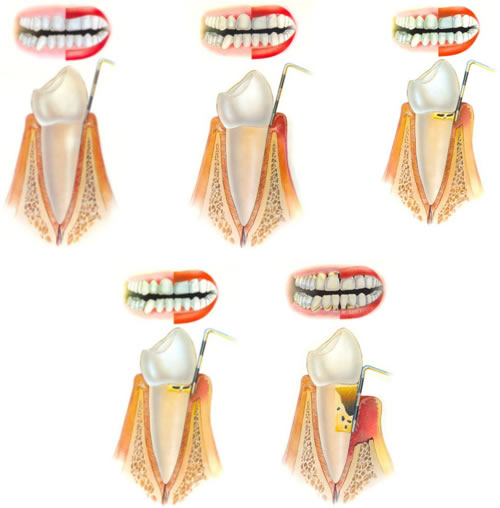 Odontologia Aila Cruvinel: Periodontite