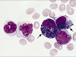 Medical Center: Acute Myeloid Leukemia