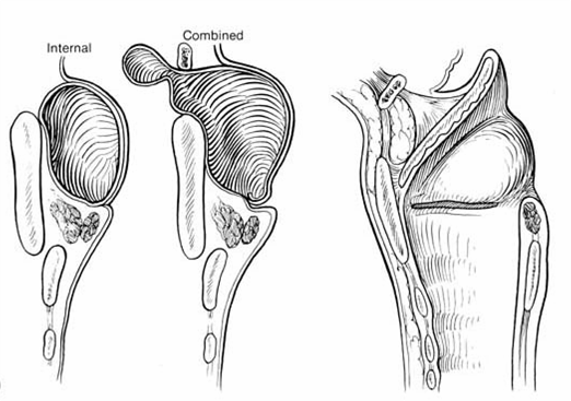 Medical Lecture Notes Online: Congenital Laryngeal Anomalies