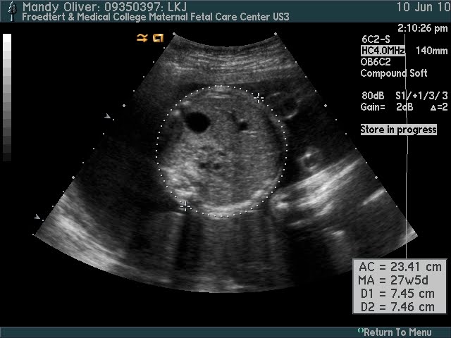 Olive Juice: Pyelectasis, Ultrasounds & Contractions