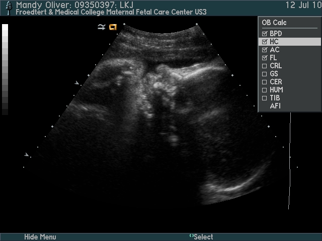 Olive Juice: Pyelectasis, Ultrasounds & Contractions