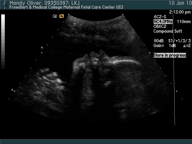 Olive Juice: Pyelectasis, Ultrasounds & Contractions