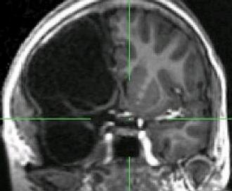 Social Neuroscience: Born with half a brain, woman living full life