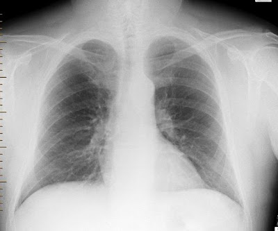 Continuous Diaphragm Sign