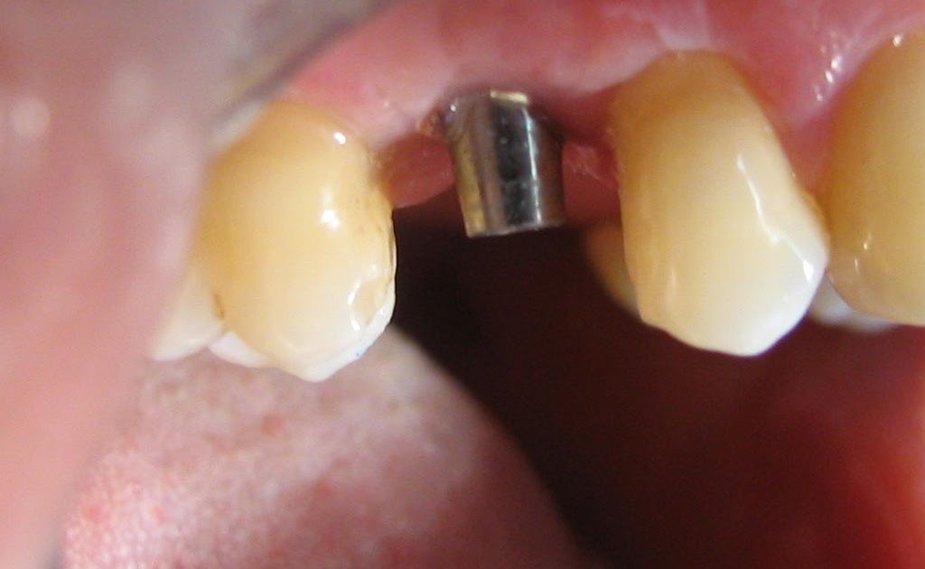 Casos Clinicos de Implantes: Implante unitario en un pre-molar superior ...
