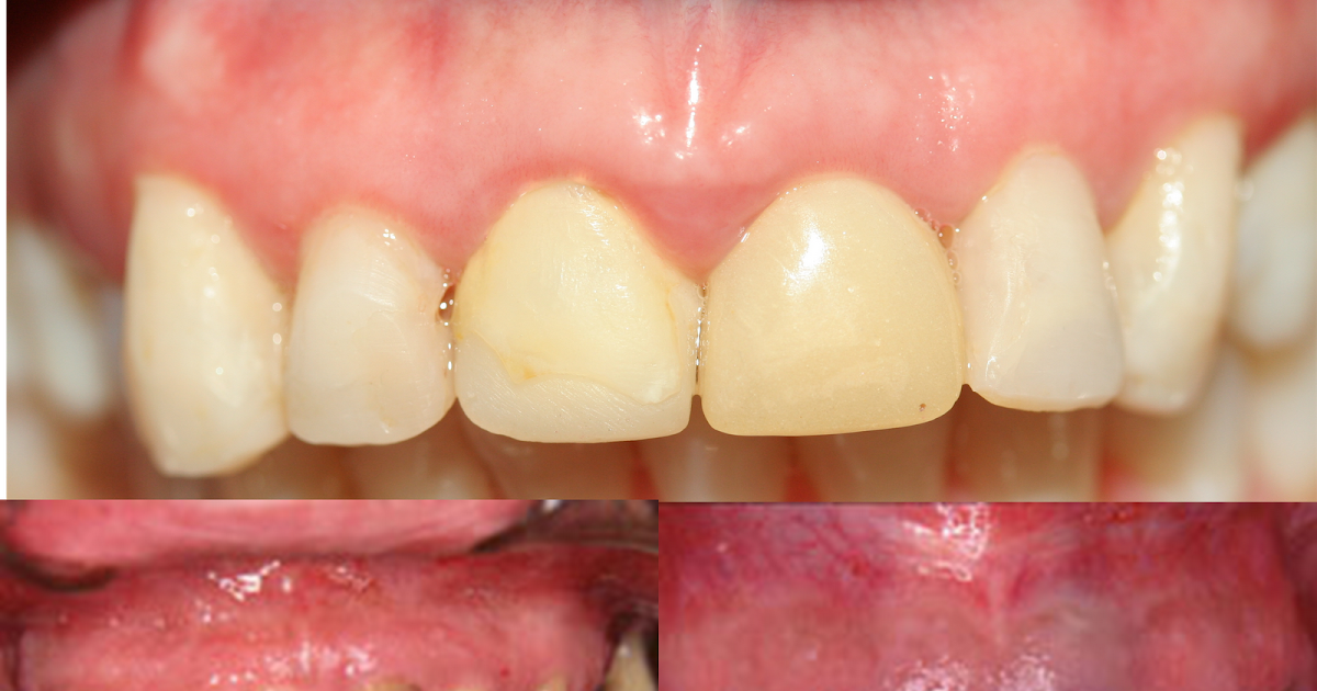 TRATAMIENTOS DENTALES: ¿Que debo hacer para tener una encía sana?