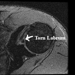 CT/MRI PATHOLOGY BLOG: SHOULDER PATHOLOGY-TORN LABRUM