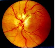 Neuritis: Neuritis Retrobulbar Adalah