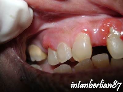 Multiple periodontal abscess in diabetic patient berserta gambar | Bila ...
