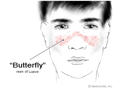 Healthy Life: Kenali “Lupus”....si kupu-kupu
