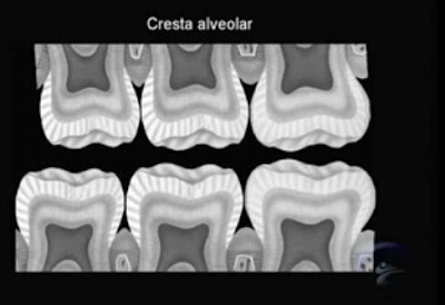 El blog de radio: Cresta Alveolar en Radiografías