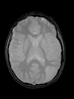 Rob's Radiology: 6-23-2009 Case 1 - DNET