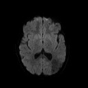 Rob's Radiology: 6-23-2009 Case 1 - DNET