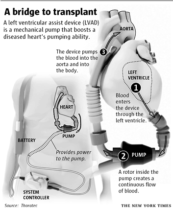 FromTheBottomOfMyLVAD With A Thoratec HeartMate II: THE LVAD IN AN ...