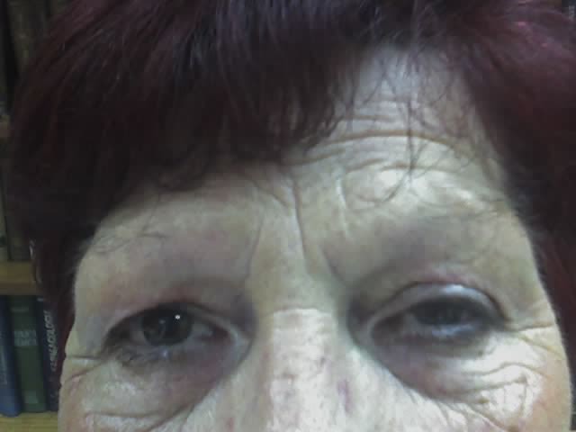 Apuntes de Neurologia: Cual es el diagnostico?Sindrome de Horner